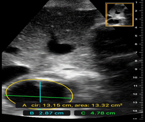 “Dissecção Aórtica” on eScholarship