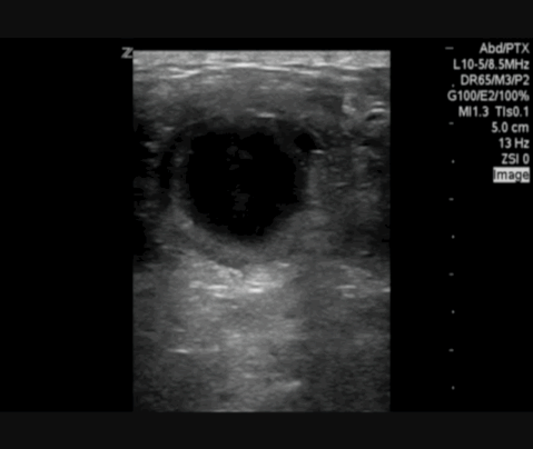 “Occlusion intestinale grêle secondaire à une hernie ombilicale ...