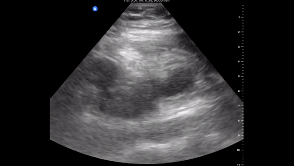“Occlusion intestinale grêle due à la tuberculose intestinale” in ...