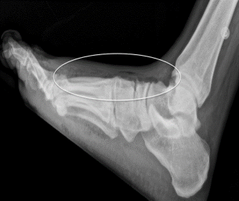 “Infection Nécrosante des Tissus Mous” on eScholarship