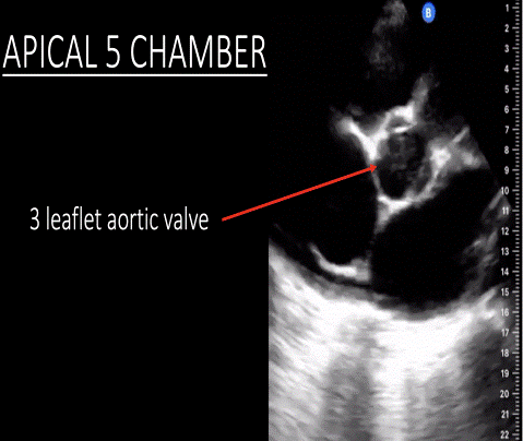 “Dissection Aortique” on eScholarship