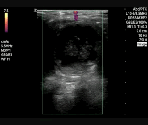 “Occlusion intestinale grêle secondaire à une hernie ombilicale ...