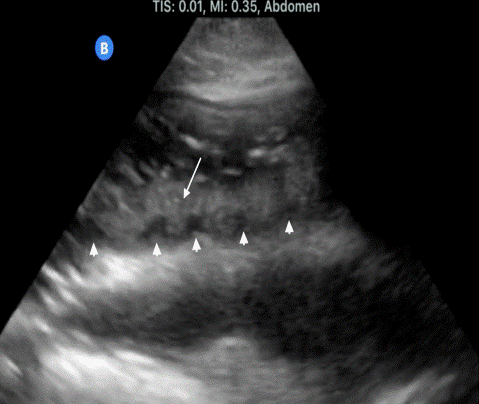 “Occlusion intestinale grêle due à la tuberculose intestinale” in ...
