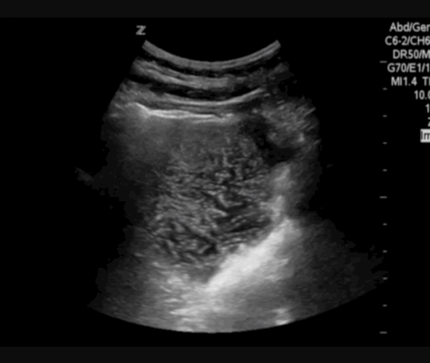 “Occlusion intestinale grêle secondaire à une hernie ombilicale ...
