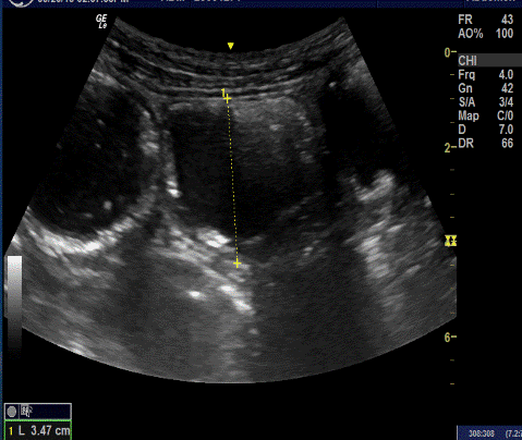 “Point-of-Care Ultrasound Diagnosis of High Grade Small Bowel ...
