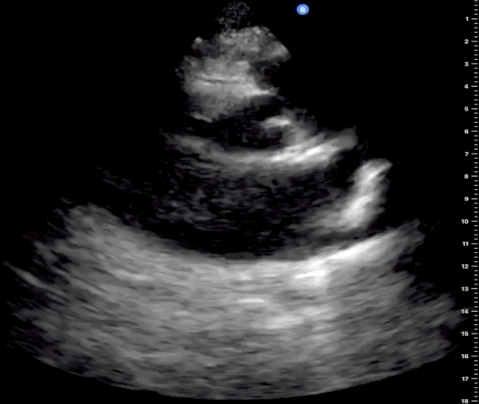 “Cardiopathie Rhumatismale” on eScholarship