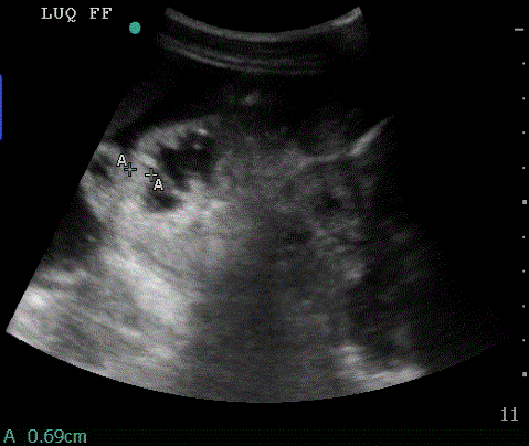 “Fiebre Tifoidea con Perforación Intestinal” on eScholarship