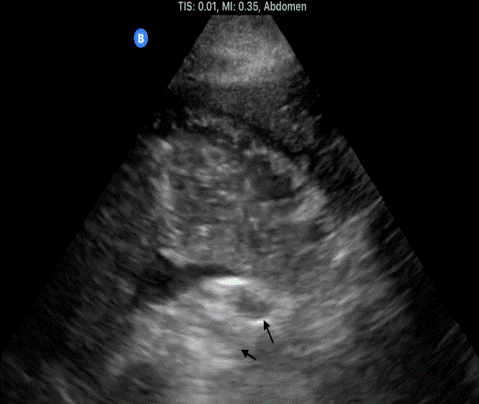 “Occlusion intestinale grêle due à la tuberculose intestinale” in ...
