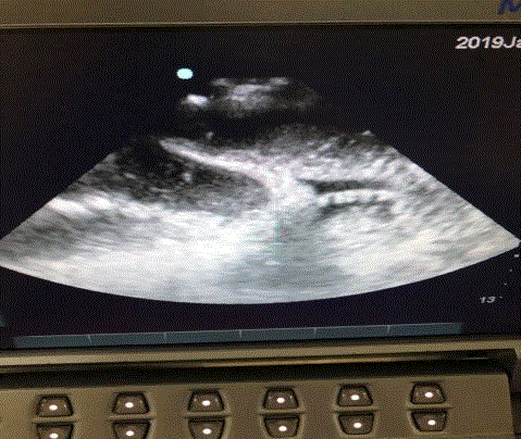 “Occlusion de lintestin grêle” in “Occlusion Intestinale Grêle de Haut ...