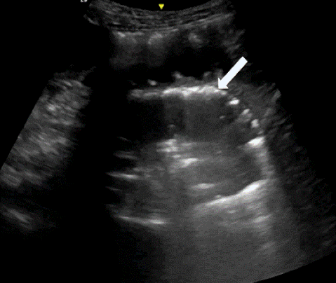 “Point-of-Care Ultrasound Diagnosis of High Grade Small Bowel ...