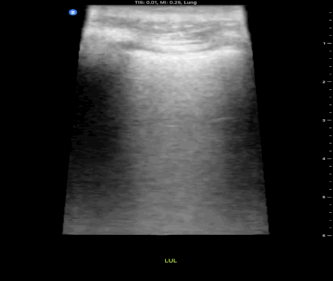 “Neumonía por Pneumocystis” on eScholarship