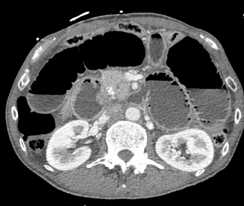 “Diagnóstico de Obstrução Intestinal Alta & Pneumatose Intestinal com ...