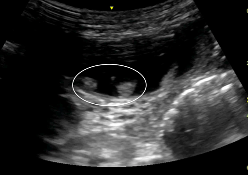 Occlusion intestinale grêle de haut grade et pneumatose intestinale ...