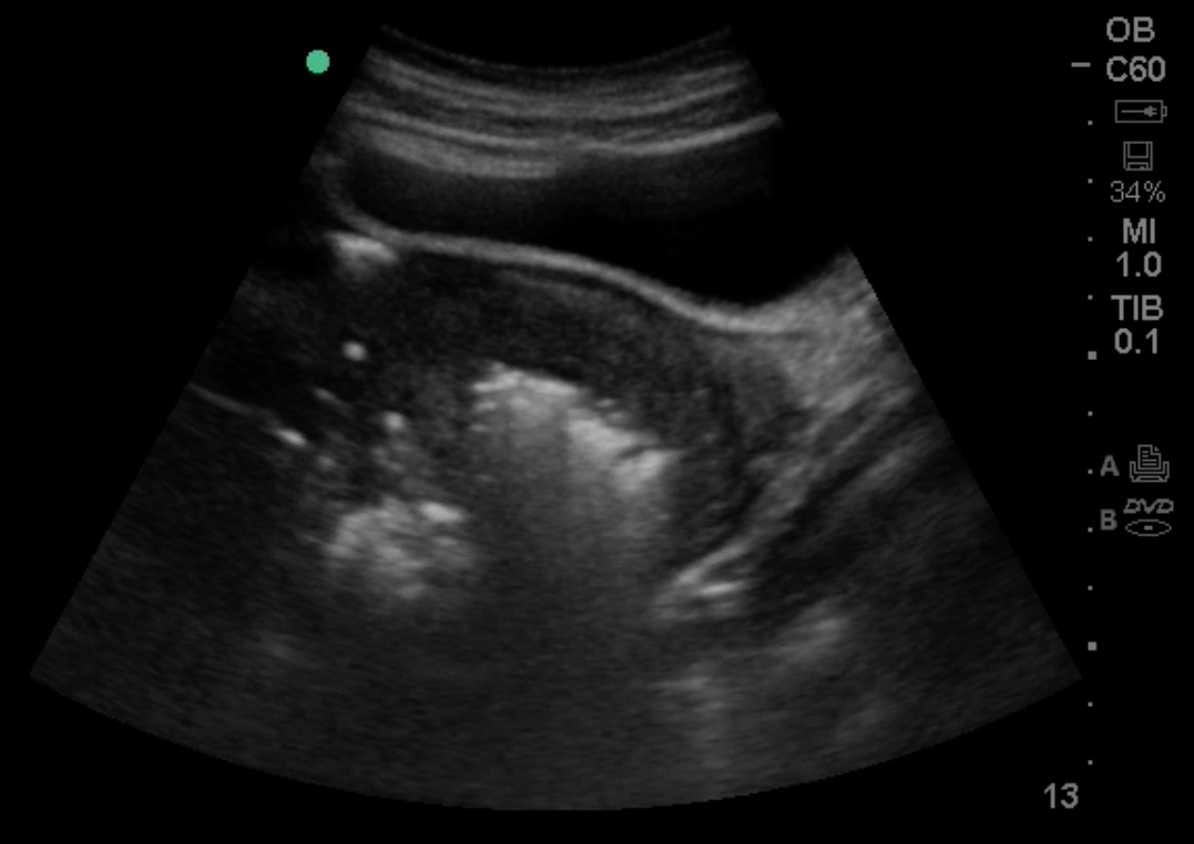 Necrotizing Endomyometritis: Image 2 | Ultrasound in Resource-Limited ...