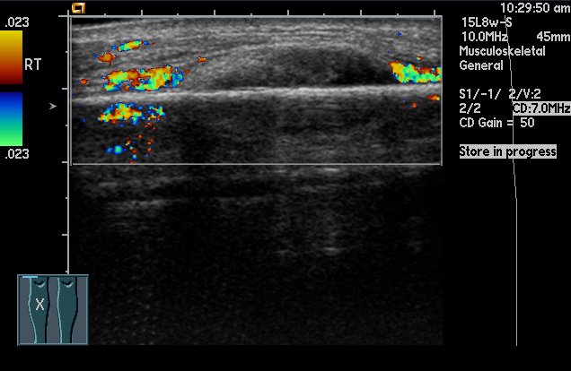 “Absceso subperióstico” in “Absceso Subperióstico” on eScholarship