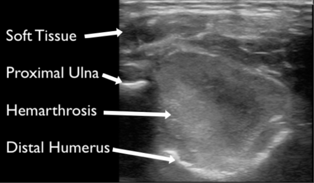 Supracondylar Fracture: Image 3, Transverse View, Hemarthrosis ...