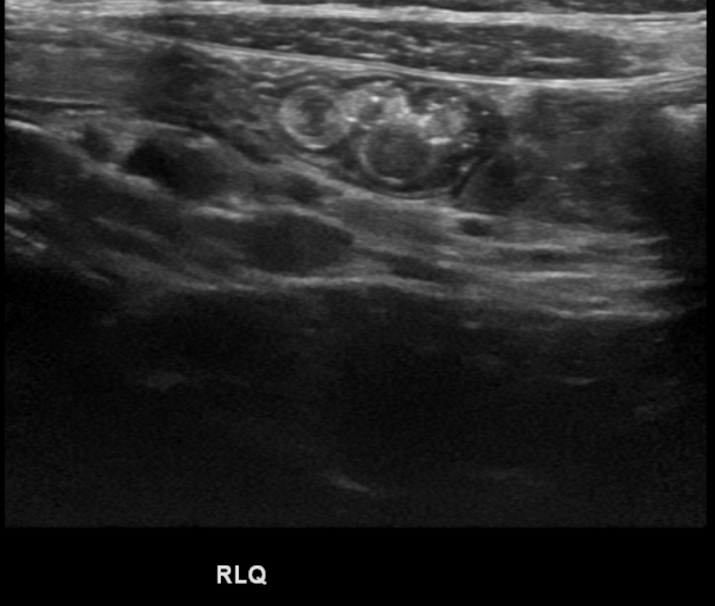 Ascariasis: Image 2 | Ultrasound in Resource-Limited Settings: A Case ...