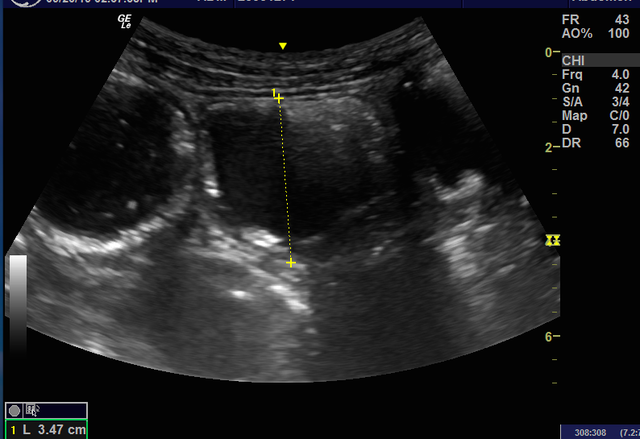 Occlusion intestinale grêle de haut grade et pneumatose intestinale ...