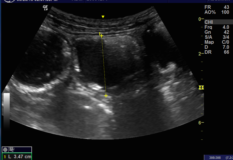 Occlusion intestinale grêle de haut grade et pneumatose intestinale ...