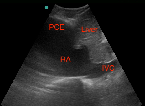 “Endomiocardiofibrose” in “Fibrose Endomiocárdica Tropical” on eScholarship